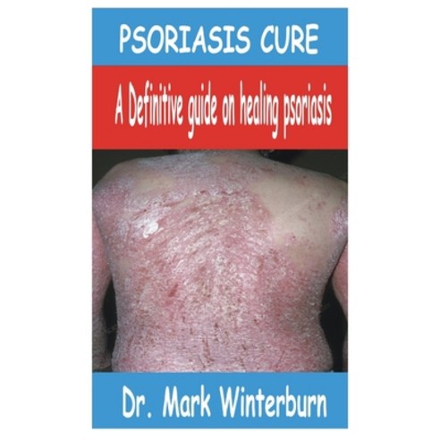 (영문도서) Psoriasis Cure: A Definitive guide on healing psoriasis ...